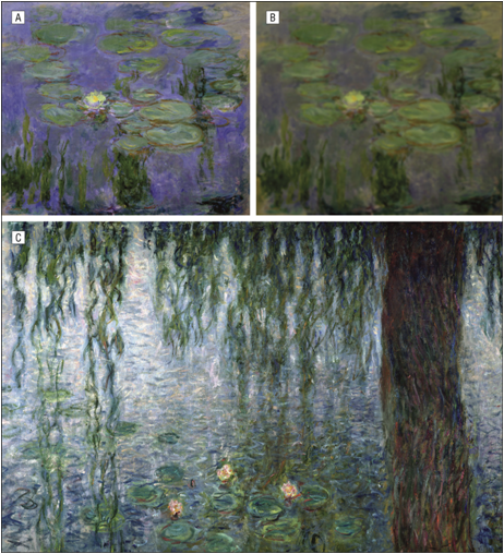 Foco no papel da Oftalmologia nas Artes (Claude Monet) – Catarata Refrativa